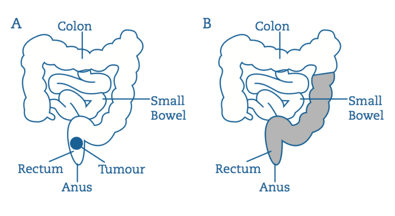 da Vinci® assisted Low Anterior Resection in Tijuana, Mexico | Angeles ...
